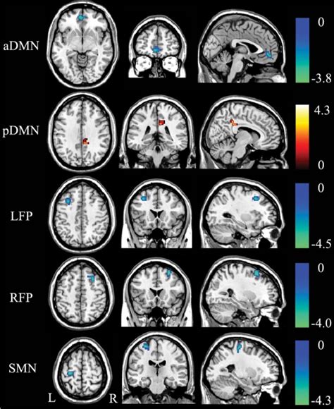 Altered Resting State Brain Activity In Obstructive Sleep Apnea Pmc