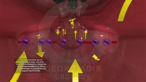 Everything About Chronic Prostatitis Georgiadis Urology