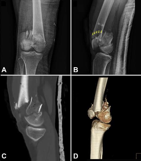 A D A A 33 Year Old Male With Old Tibia Fracture Sustained New Open Download Scientific