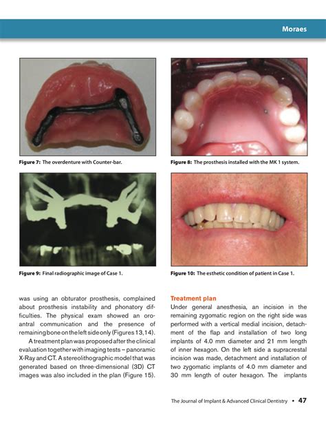 Integrating Implant Function And Esthetics Jiacd Page 47 Flip Pdf