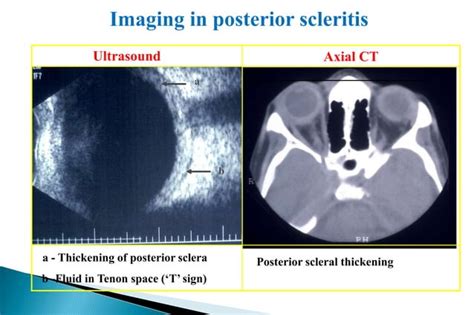 Scleritis Ppt