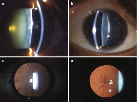 Cataract Grading Systems Springerlink