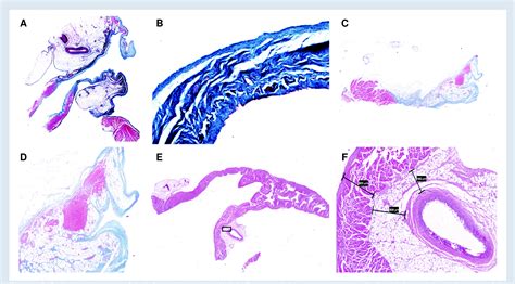 Figure 3 From Safety And Efficacy Of The Second Generation Cryoballoon