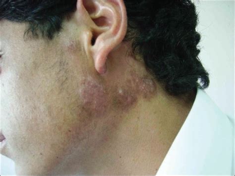 Use Of Topical Povidone Iodine Resulting In A Iododerma Pmc