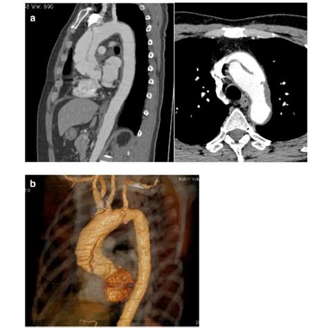 Postoperative Multidetector Computed Tomography Mdct Scan Showing