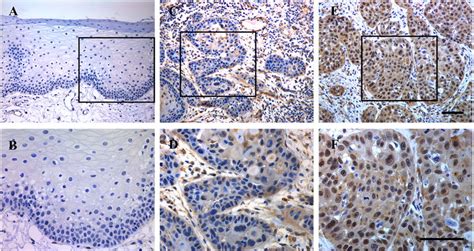 Immunohistochemical Staining Of Tead4 In Human Hnscc Samples A B
