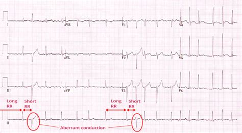 Ecg Criteria For Atrial Fibrillation 2026