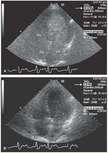 Contrast Echocardiography Thoracic Key