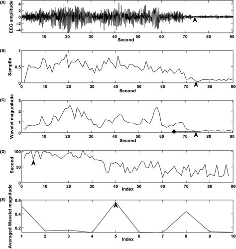 A Electroconvulsive Therapy Ect‐induced Eeg Seizure For Which The