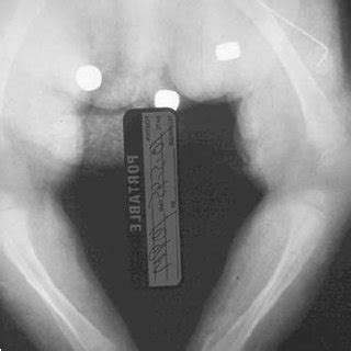 Radiograph Shows Extensive Subcutaneous Calcification Of The Left Upper Download Scientific