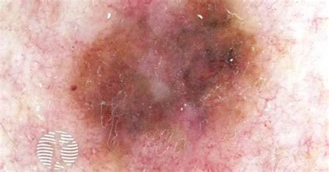 Dermoscopy Image