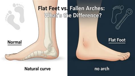 Difference Between Flat Feet Vs Fallen Arches Insoles For Flat Feet
