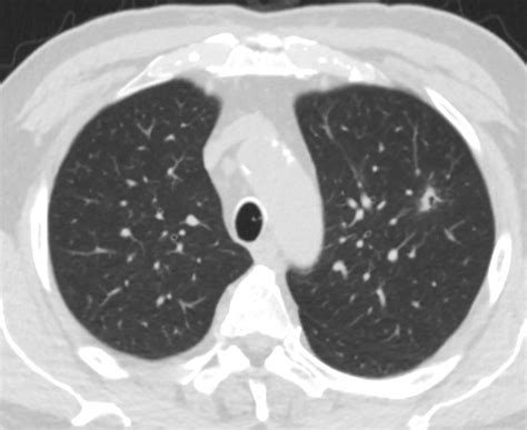 Nodules And Masses Cavitating Links On Web The Common Vein