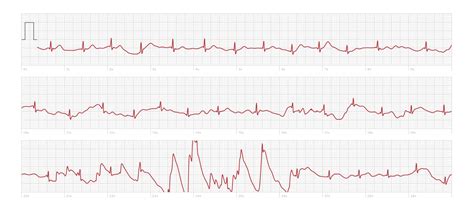 False Positive Afib R Readmyecg