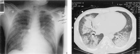 Left Chest Radiograph Showing Diffuse Bilateral Infiltrates In The Download Scientific