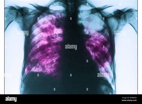 Mycoplasma Pneumonia Chest X Ray At Kathleen Phillips Blog