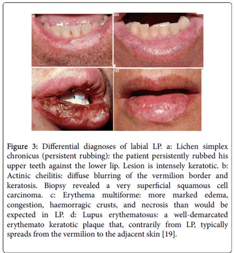 Oral Lichen Planus Lips
