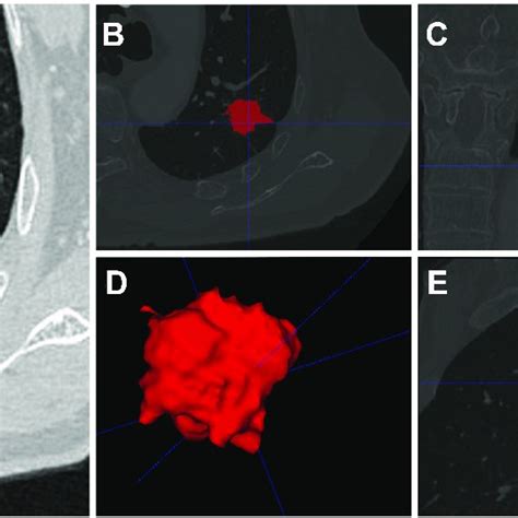 Lung Adenocarcinoma In The Apicoposterior Segment Of The Left Upper Download Scientific Diagram