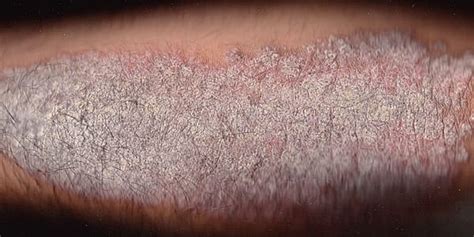 Severe Psoriasis Linked With Poorly Controlled Blood Pressure Minute Medicine