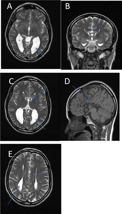A Axial T2 Brain Mri Sequence With Dilatation Of The Occipital Horns Download Scientific