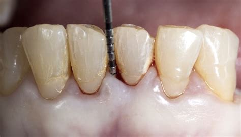 Tips On Periodontal Probing