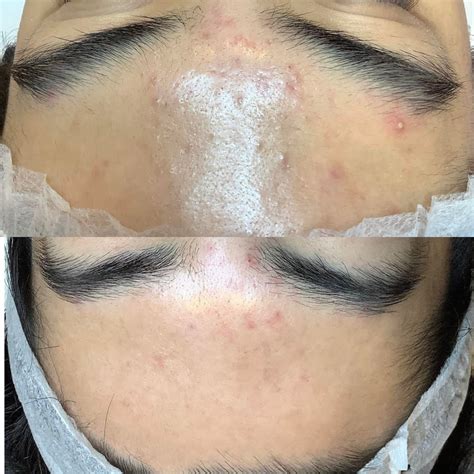 Congested Skin Treatments Wimbledon And Kensington London