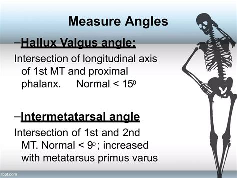 Hallux Valgus Pptx
