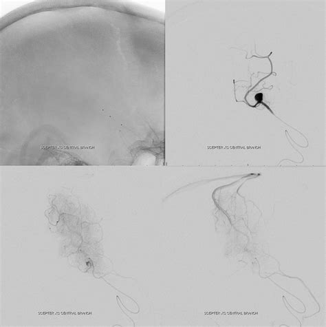 Balloon Test Occlusion