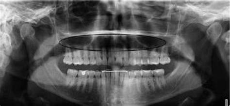 Xray Of Front Teeth