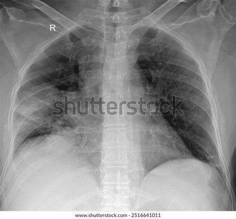 Pulmonary Abnormality Photos Images And Pictures Shutterstock