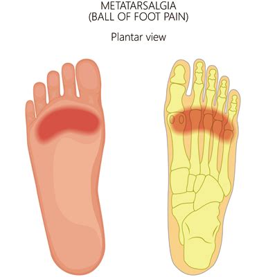 발바닥 통증 서재곤링커병원