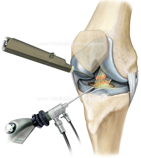 Arthroscopy Of The Knee Joint Medical Stock Images Company