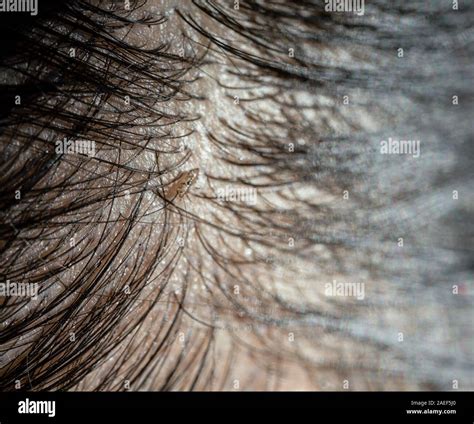 Head Lice Eggs