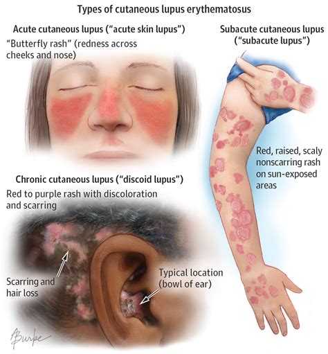 Cutaneous Lupus Erythematosus Cle Is Lupus Affecting The Skin In This Autoimmune Disease The