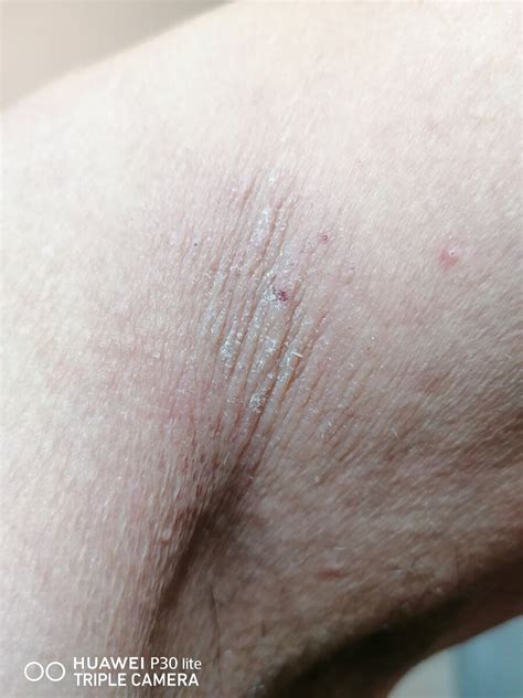 Psioriasi Psoriasi DermaClub Forum