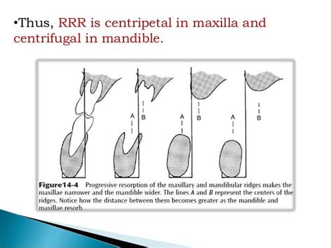 Residual Ridge Resorption