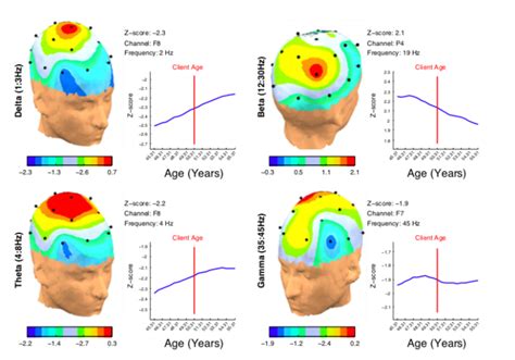 Discover The Benefits Of QEEG Brain Mapping