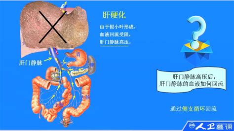 【人卫慕课】肝门静脉侧支循环高清1080p在线观看平台腾讯视频