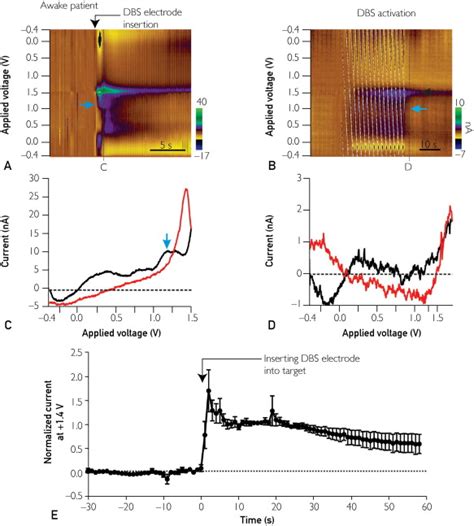 Wireless Fast Scan Cyclic Voltammetry To Monitor Adenosine In Patients With Essential Tremor