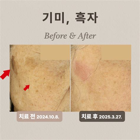 60대 여성 기미 흑자 치료 후기 강남 대치동 한티 피부과 전문의 루미인피부과