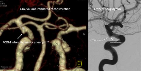 Infundibulum Brain Artery Pdf] Differential Diagnosis Of The