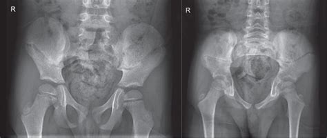 Radiography With Formation Of Callus Visible After Six Weeks Download Scientific Diagram