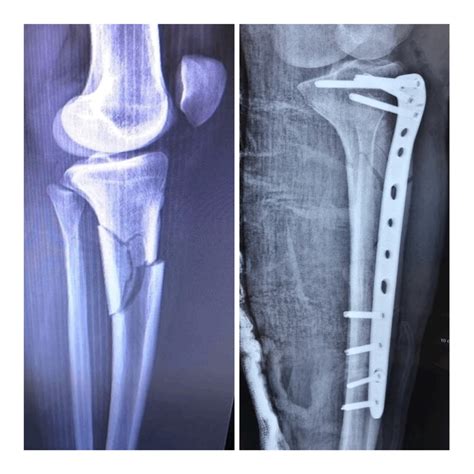 Gravity Based Minimal Invasive Plate Osteosynthesis For Proximal Tibia Fractures A Novel