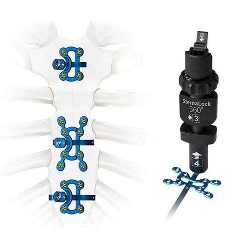 The Role Of Sternal Plating In Cardiac Surgery Gold Coast