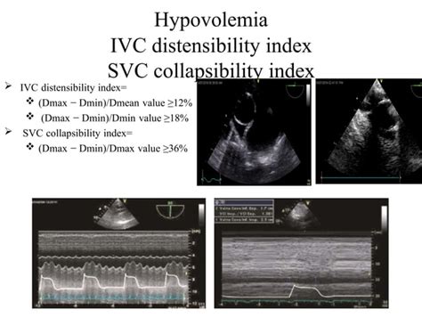 Basics Of Tte And Tee Trans Esophageal Echopptx