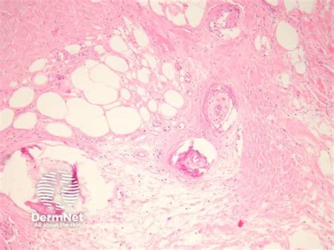 Calciphylaxis Histology