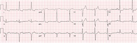 Stemi Infarction Ecg Book