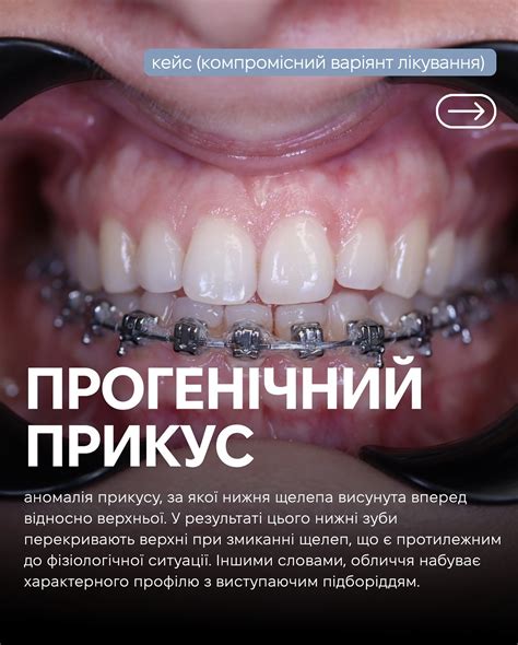 стоматологія Львів відбілювання•імплантація•вініри•ортодонт Орієнтовно до 12 років діти не