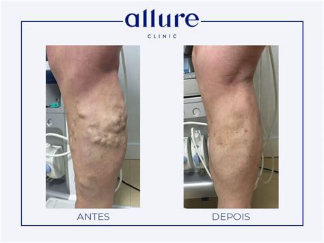 Reparo De Varicocele Antes E Depois Importante Reconhecer Os Sintomas
