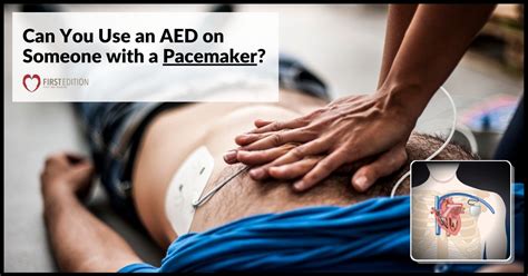 Can You Use An Aed On Someone With A Pacemaker First Edition Aed Calgary
